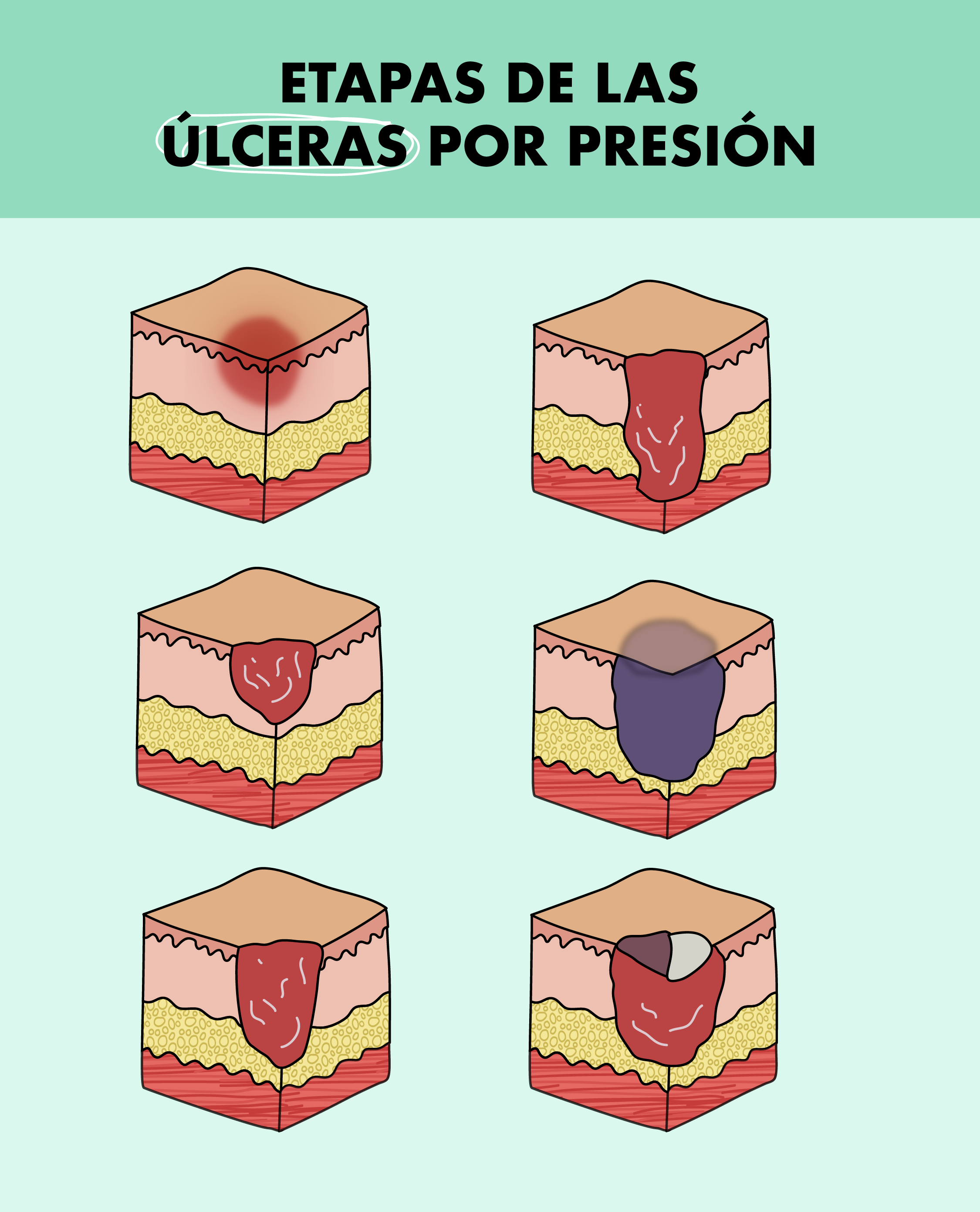 Etapas de las úlceras por presión | BLOG – Enfermera en apuros